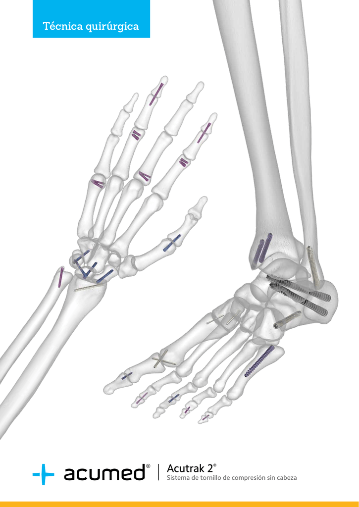 Acutrak 2® Técnica quirúrgica