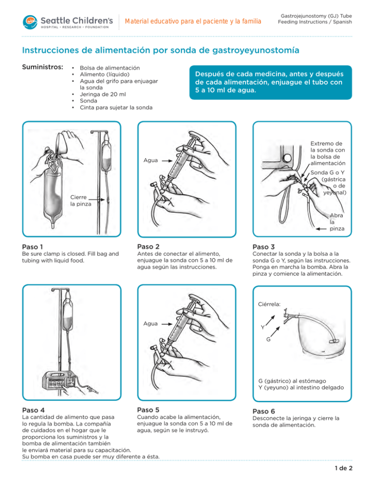 PE1701S Gastrojejunostomy (GJ) Tube Feeding Instructions