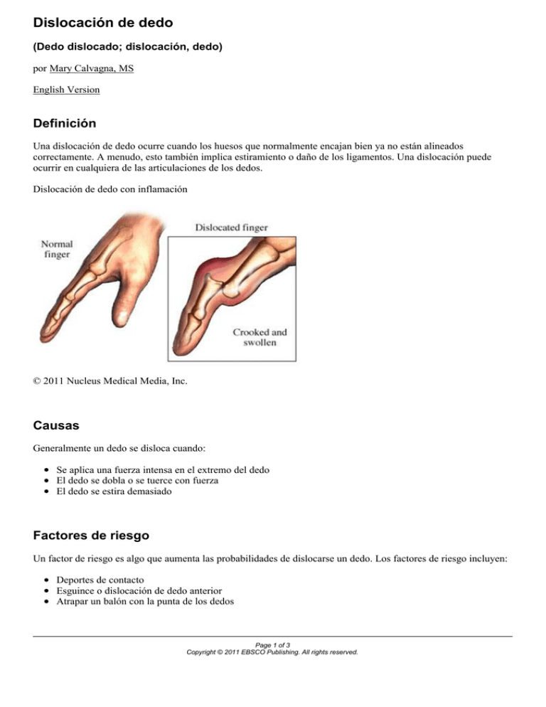 Dislocación de dedo