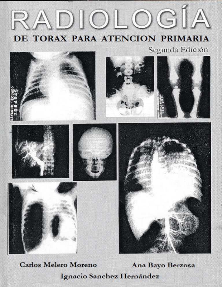 Radiologia de Torax para Atencion Primaria