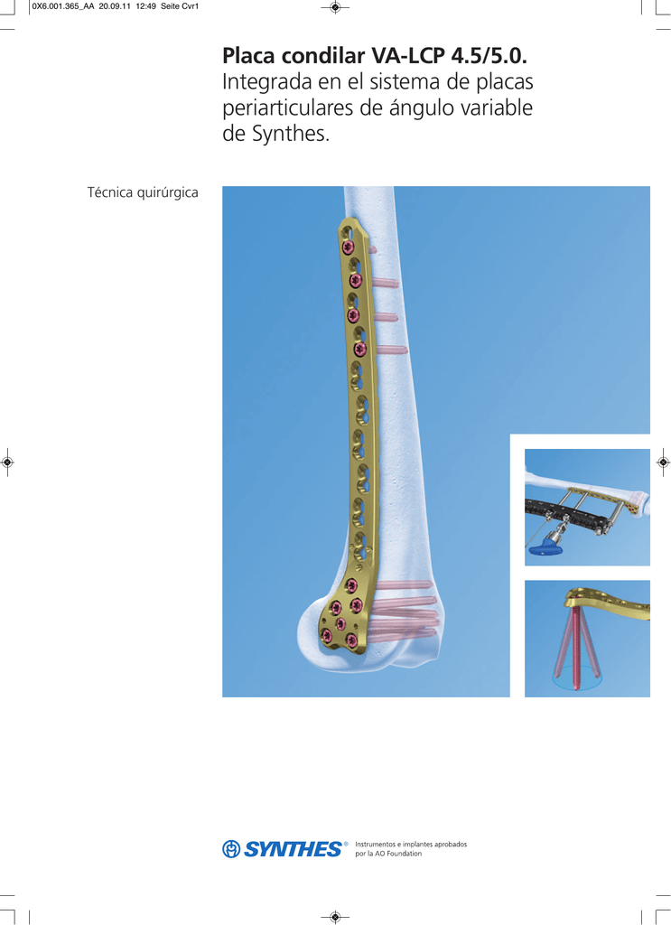 Placa condilar VA-LCP 4.5/5.0. Integrada en el sistema de placas