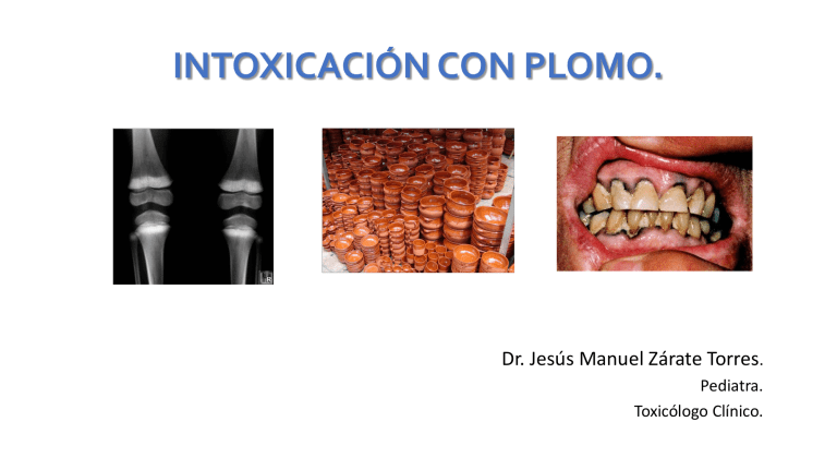 Intoxicación por plomo: síntomas, diagnóstico y prevención en México